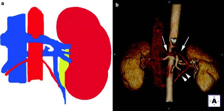 Normal Radiological Anatomy and Anatomical Variants of the Kidney ...