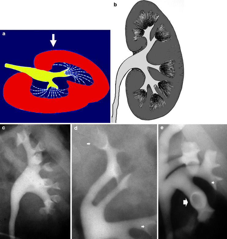 Normal Radiological Anatomy and Anatomical Variants of the Kidney ...