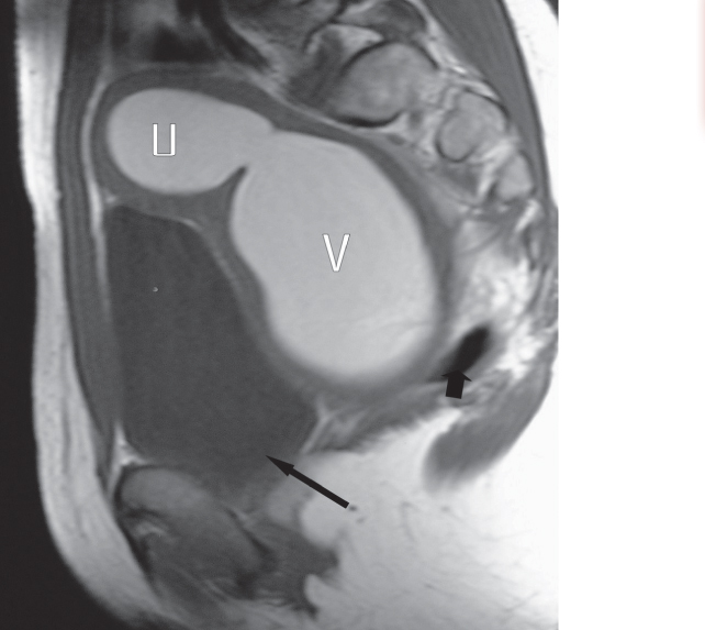 Hematometrocolpos (Hydrometrocolpos) | SpringerLink