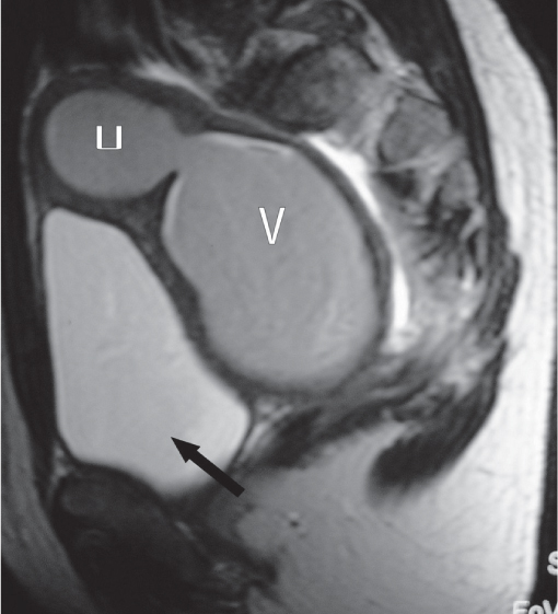 Hematometrocolpos (Hydrometrocolpos) | SpringerLink