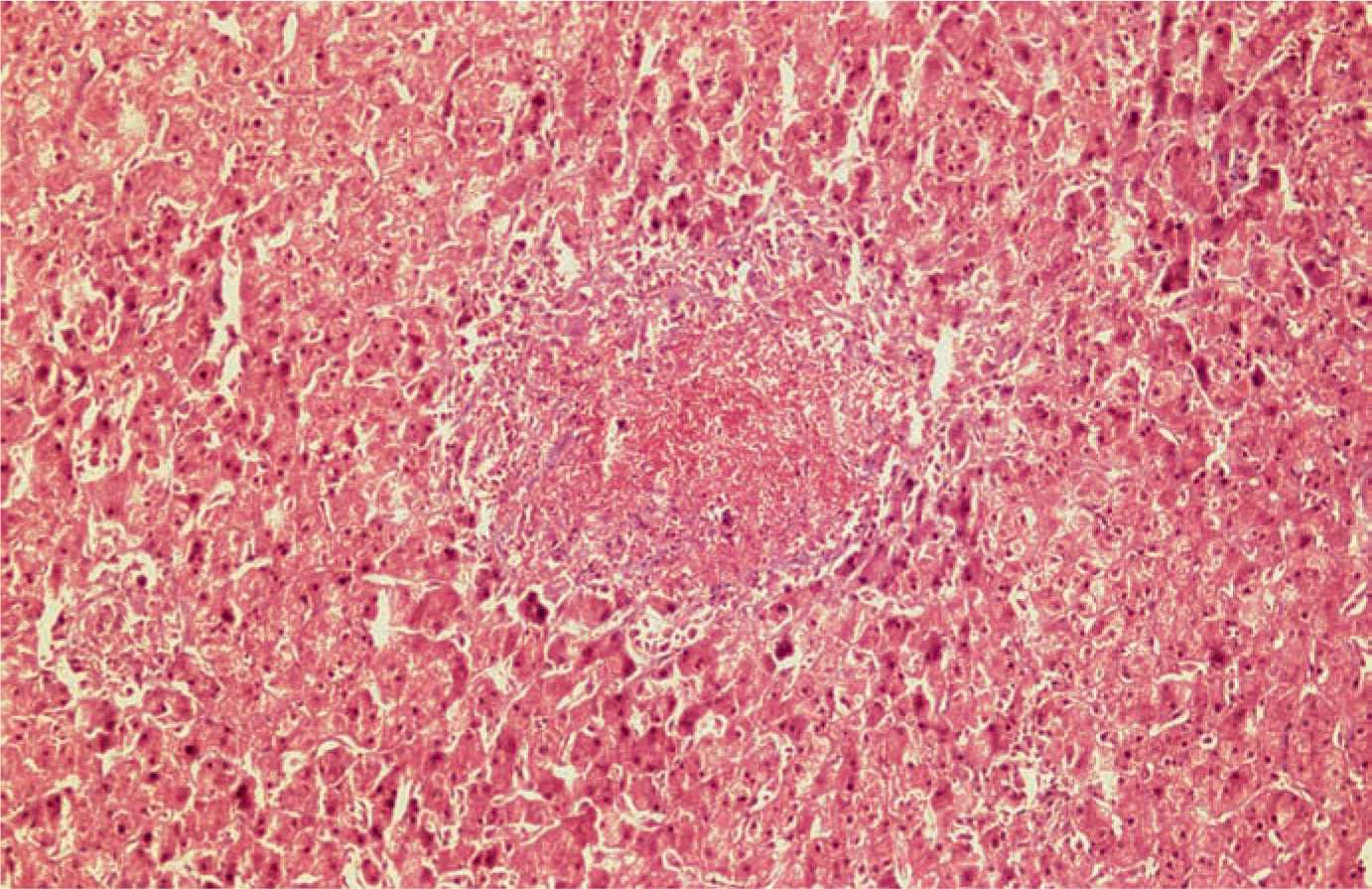 Granulomatous Reaction | SpringerLink