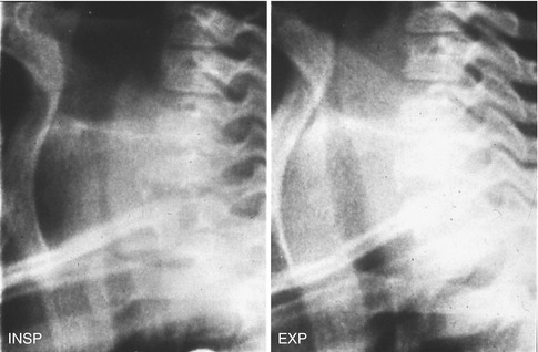 Post-extubation Stridor | SpringerLink