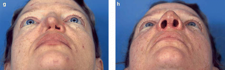 Nasal Base | SpringerLink