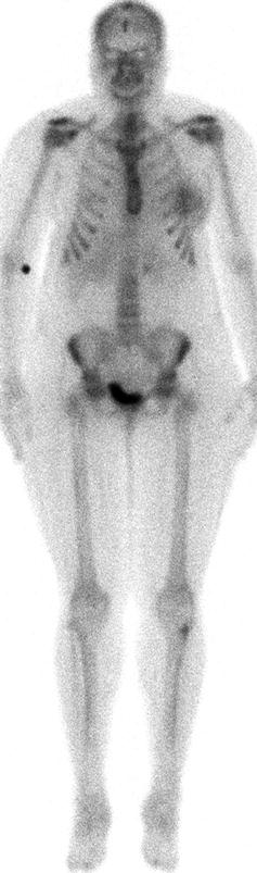 Soft Tissue Uptake in Radionuclide Bone Scintigraphy | SpringerLink