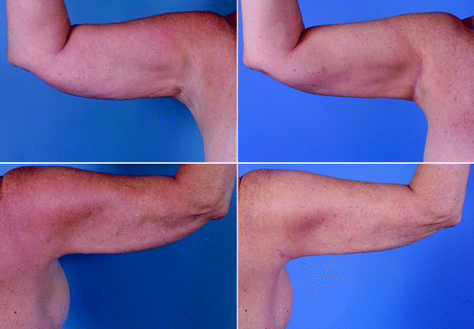 Limited Incision Medial Brachioplasty | SpringerLink