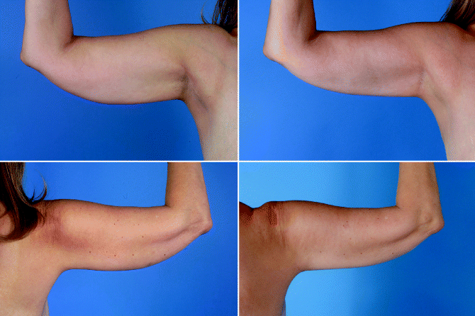 Limited Incision Medial Brachioplasty | SpringerLink