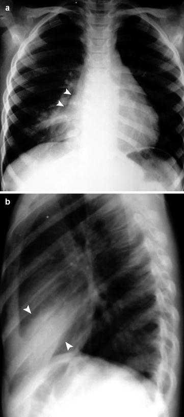 Atelectasis (Lung Collapse) | SpringerLink