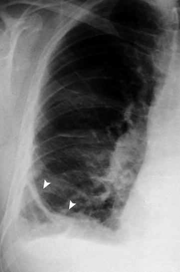 Atelectasis (Lung Collapse) | SpringerLink