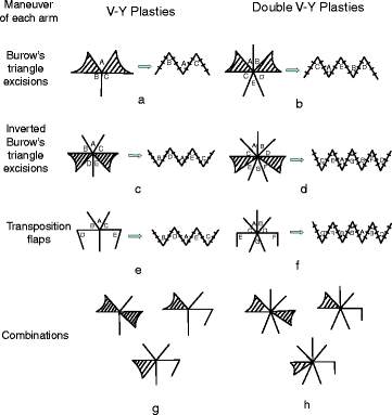 Z-Plasties and V-Y Flaps | SpringerLink
