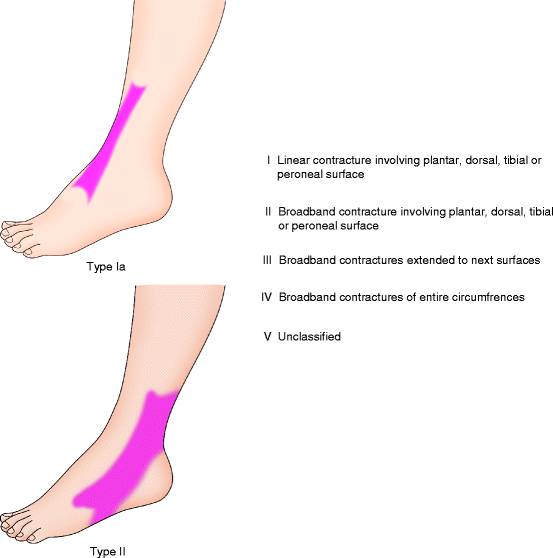 Diagnosis, Assessment, and Classification of Scar Contractures ...