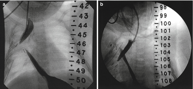 Growth Induction (the Foker Procedure) and a Flexible Approach for the ...