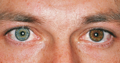 Iris und Ziliarkörper | SpringerLink