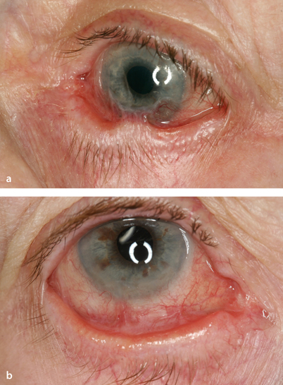 Bindehaut | SpringerLink