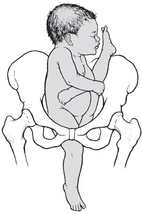 Regelwidrigkeiten des Geburtsmechanismus: Poleinstellungsanomalien ...