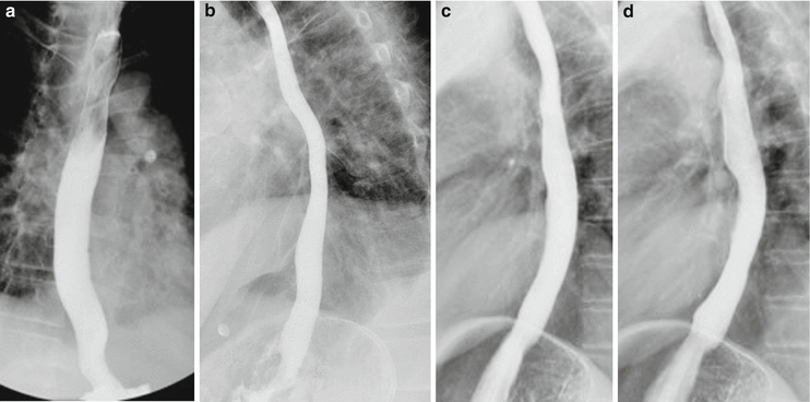Pharynx and Esophagus: Barium Studies and Fluoroscopic Evaluation ...