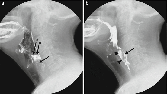 Pharynx: Normal Anatomy and Function | SpringerLink