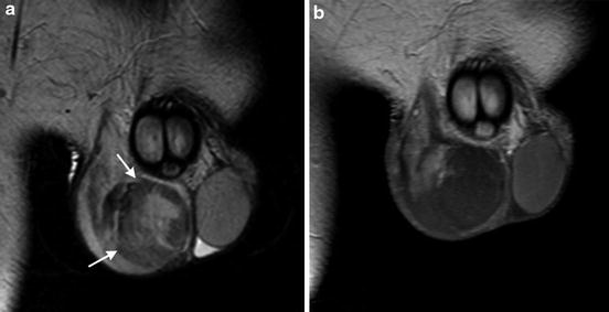 Scrotal Trauma | SpringerLink