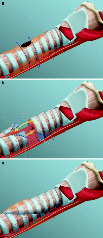 Tracheal Resection and Anastomosis | SpringerLink