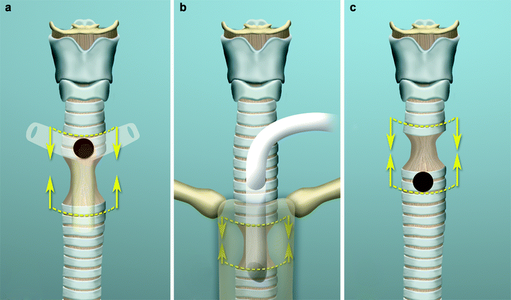 Tracheal Resection and Anastomosis | SpringerLink