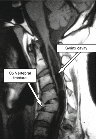 Post-traumatic and Post-inflammatory Syringomyelia | SpringerLink