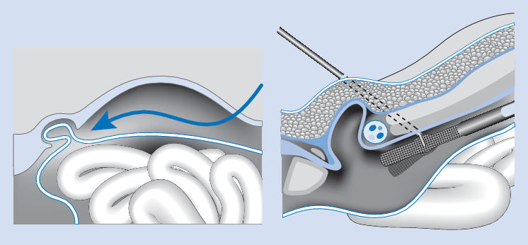 Abdominelle Hernien | SpringerLink