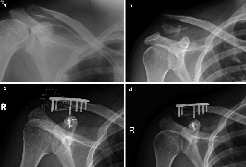 Management of the Acromioclavicular Joint Problems | SpringerLink