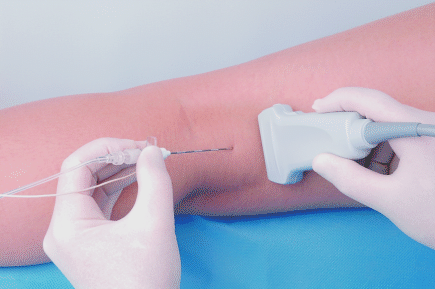 Distale N.-ischiadicus-Blockade (Poplitealblock) | SpringerLink