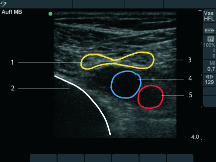 Distale N.-ischiadicus-Blockade (Poplitealblock) | SpringerLink