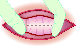 E5 Open Pyloromyotomy | SpringerLink