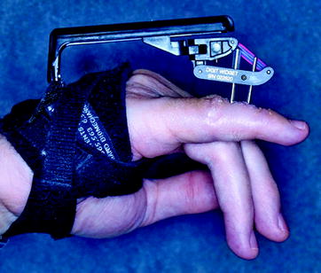 Dynamic External Fixation in the Treatment of Dupuytren’s Contracture ...
