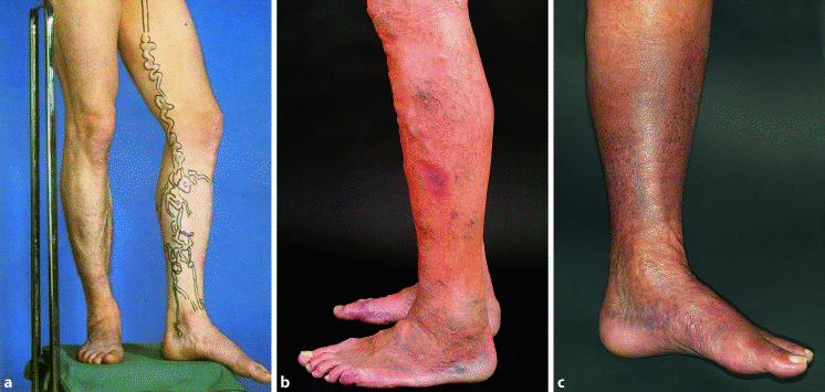 Varikose | SpringerLink