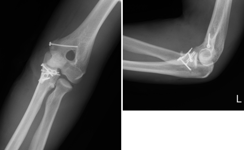 Ellbogenluxationsfraktur mit mehrfragmentärer Fraktur des Processus ...