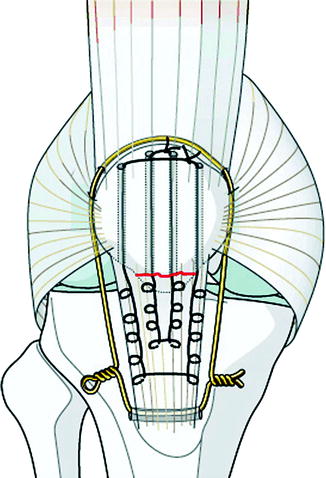 Patellar Fractures | SpringerLink