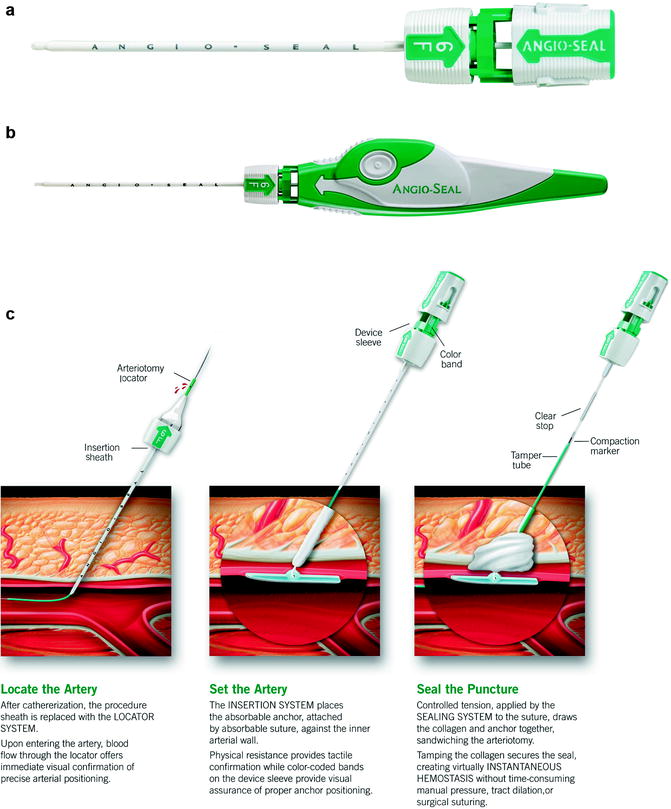 Closure of Percutaneous Vascular Access | SpringerLink