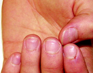 Eating Disorders and the Nails | SpringerLink