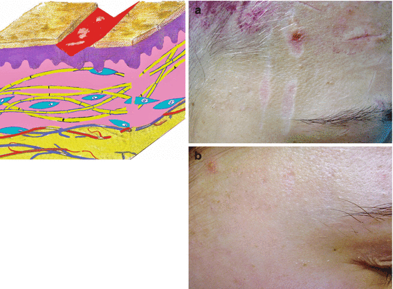 Atrophic Scars and Stretch Marks | SpringerLink