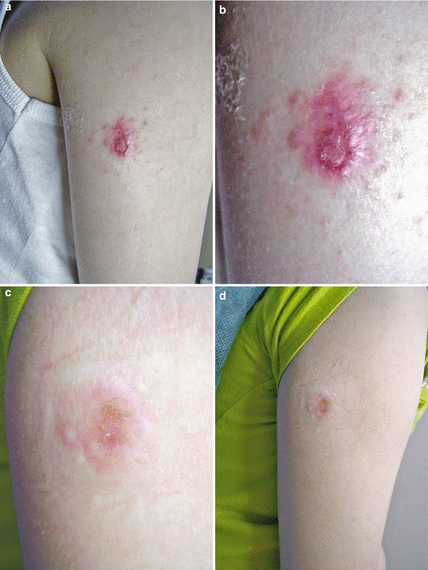 Pathological Scars (Keloid and Hypertrophic Scars) | SpringerLink