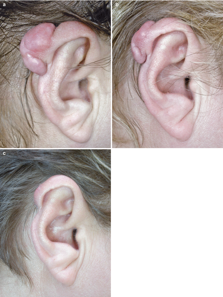 Pathological Scars (Keloid and Hypertrophic Scars) | SpringerLink