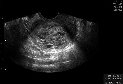 Pathologische Plazenta und Nabelschnur | SpringerLink