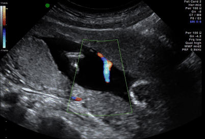 Pathologische Plazenta und Nabelschnur | SpringerLink