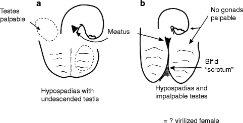 Abnormalities of the Penis | SpringerLink