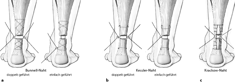 Achillessehne | SpringerLink