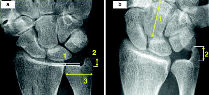 Arthrosopic Ulnar Styloidectomy for Ulnar Styloid Impaction Syndrome ...