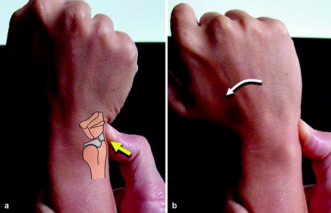 Clinical Examination of the Ulnar-Sided Painful Wrist | SpringerLink