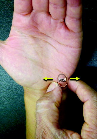 Clinical Examination of the Ulnar-Sided Painful Wrist | SpringerLink