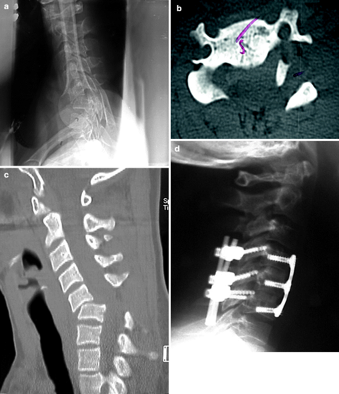 Spine Trauma: Subaxial Cervical Spine (C3–C7) | SpringerLink