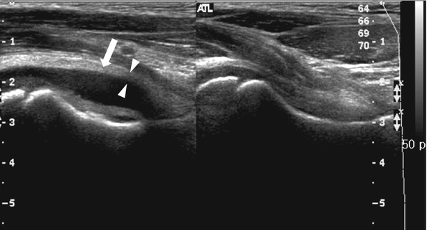 Pediatric Hip Disorders | SpringerLink