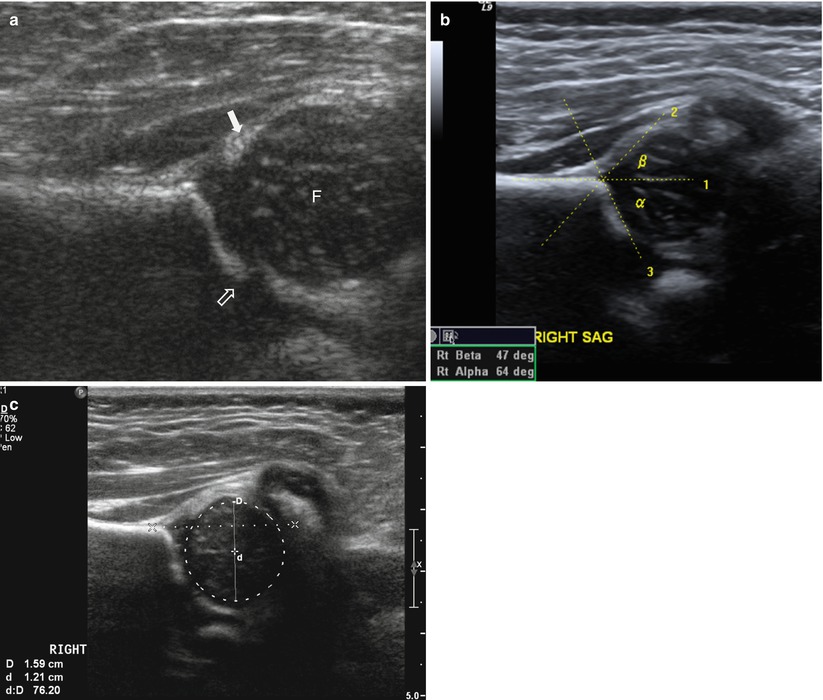 Pediatric Hip Disorders | SpringerLink