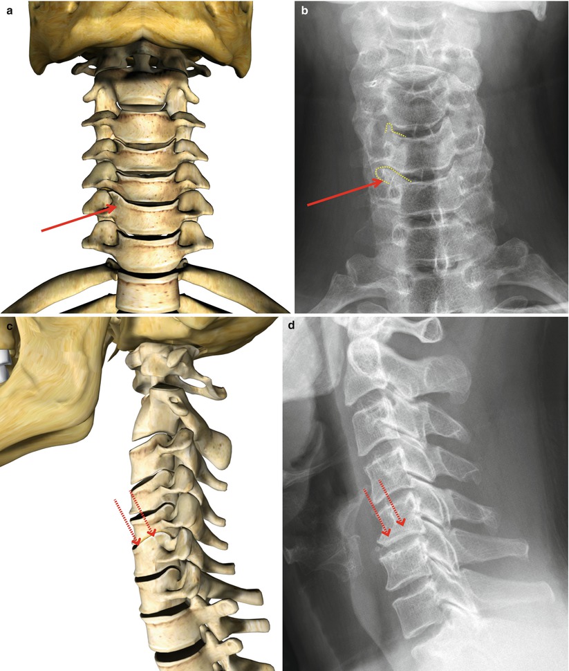 Common Spine Disorders Associated with Neck Pain | SpringerLink
