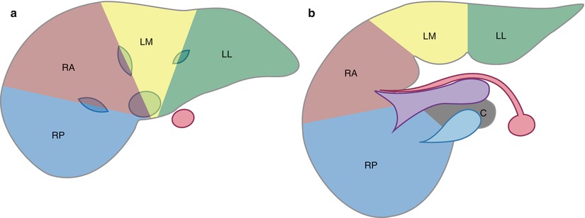 Anomalies and Anatomic Variants of the Liver | SpringerLink